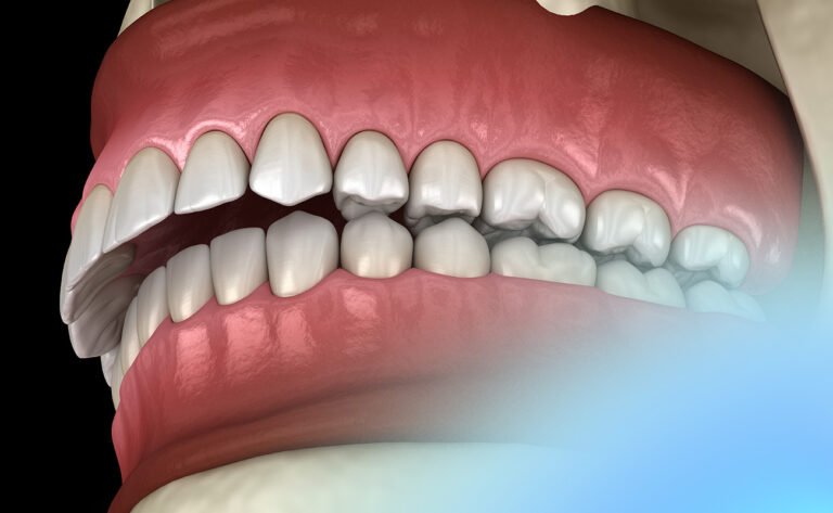 Overbite Face Shape - We Answer Frequently Asked Questions