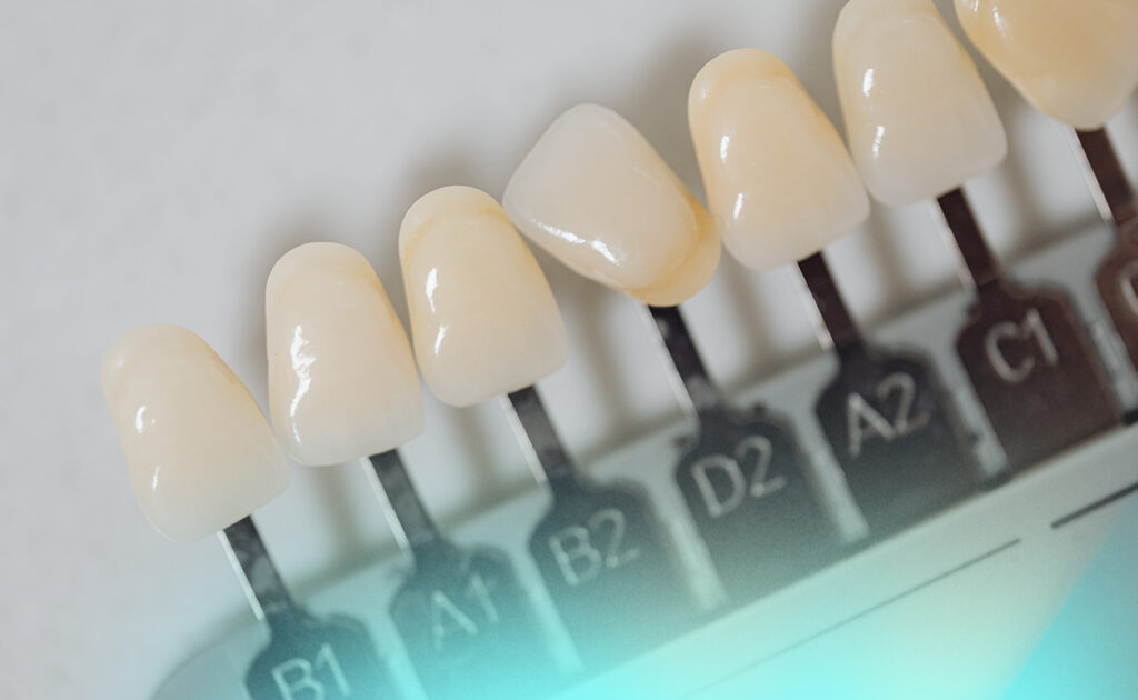 Veneers That Look Natural: Achieving a Seamless Smile