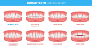 Teeth Crowding: Causes, Pain, and Remedies
